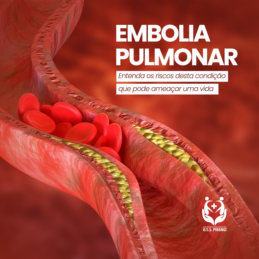 Causas De Embolia Pulmonar